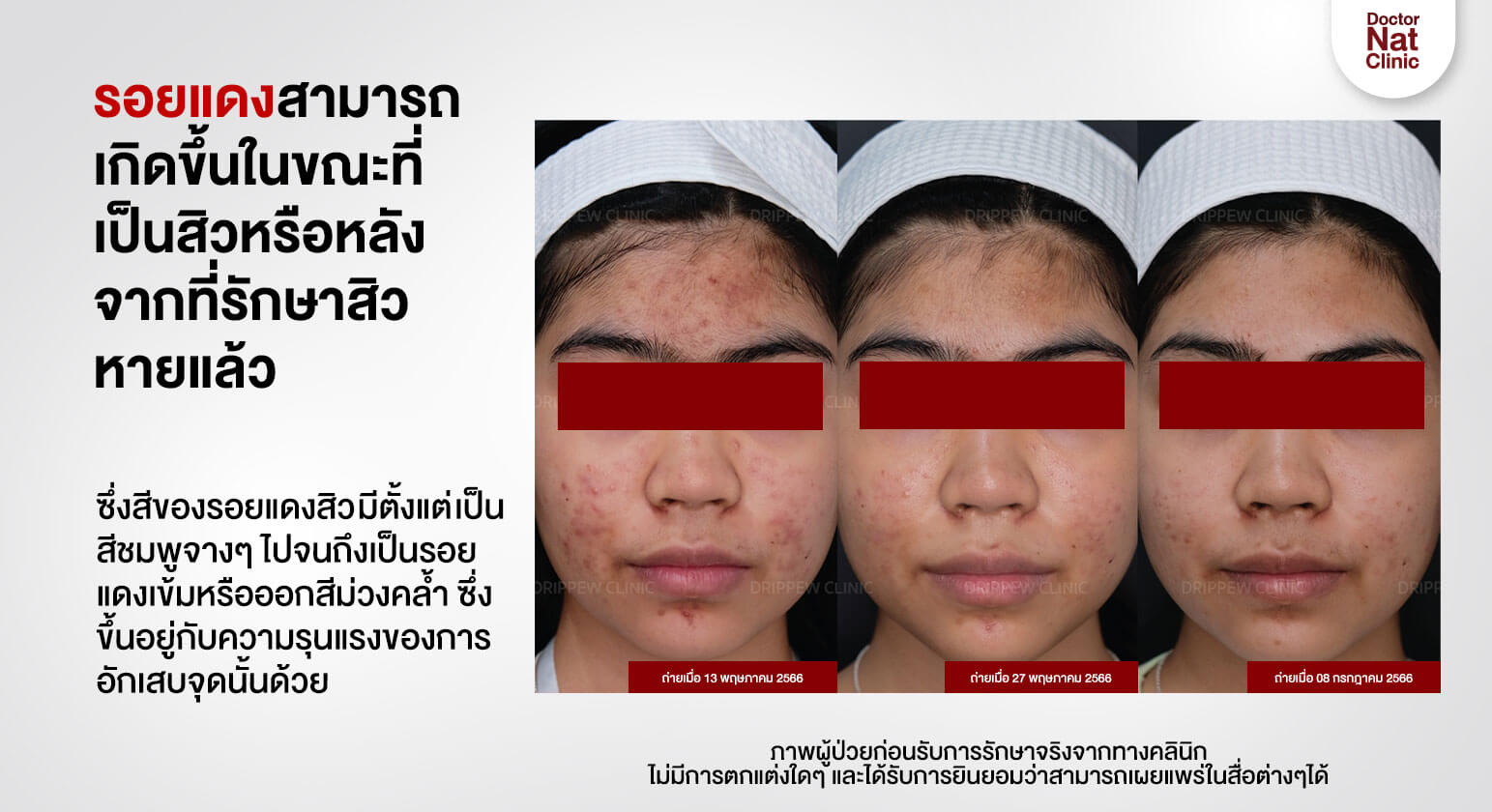 ทำไมรอยสิวมีสีต่างกัน - Doctor NAT Clinic