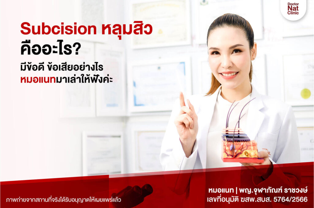 Subcision หลุมสิว คืออะไร? - Doctor NAT Clinic