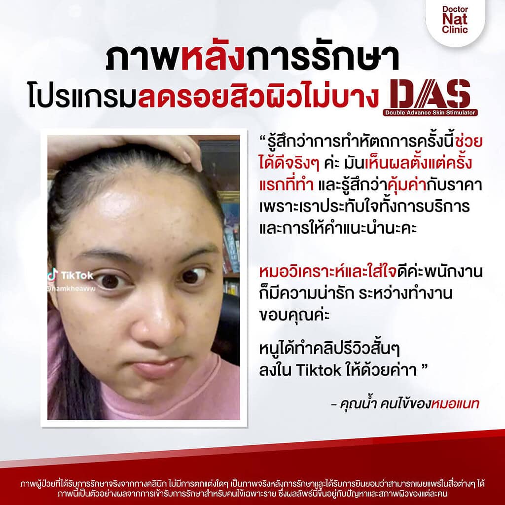 รีวิวความประทับใจโปรแกรมลดรอยสิวผิวไม่บาง DAS - Doctor NAT Clinic