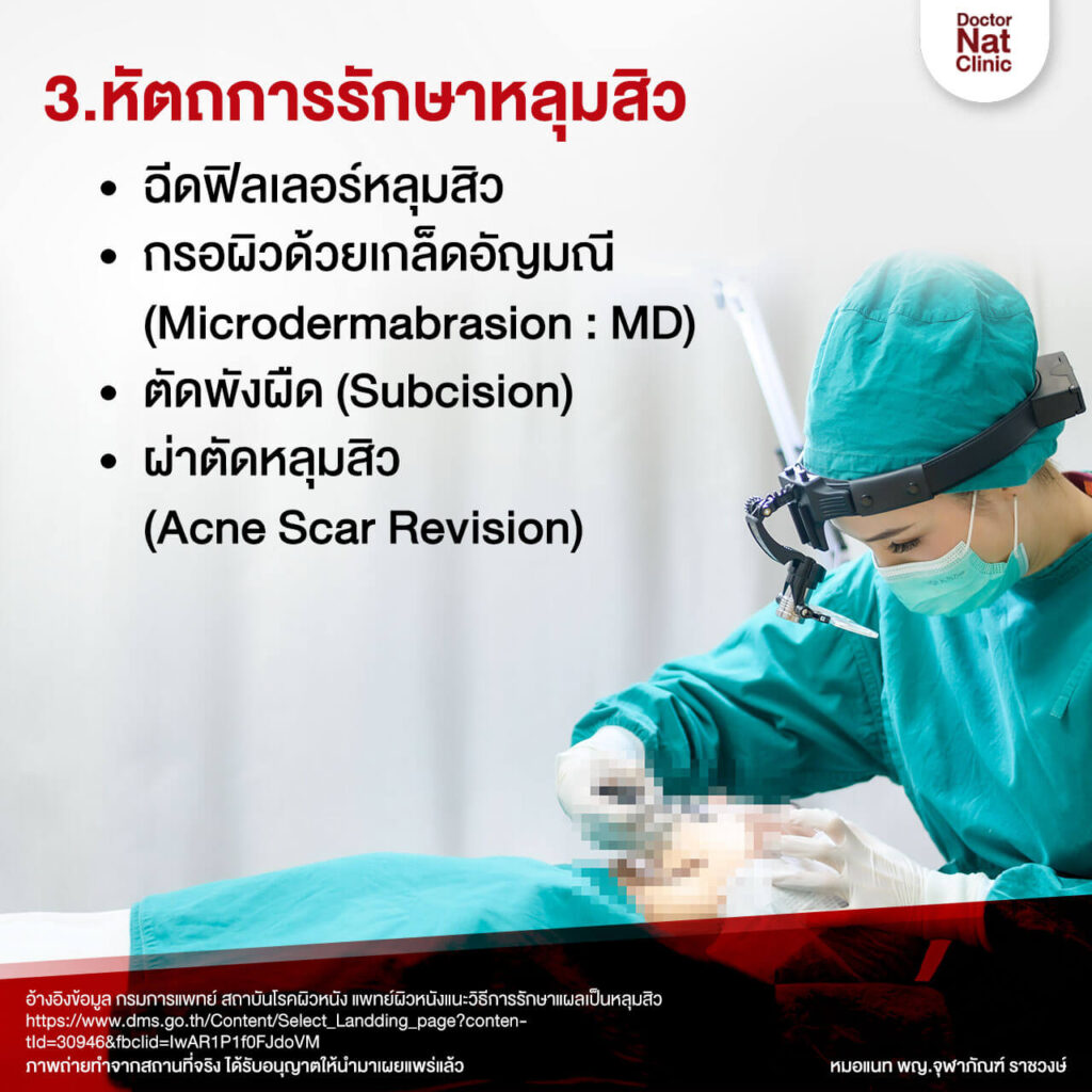 หลุมสิวมีกี่แบบ - Doctor NAT Clinic