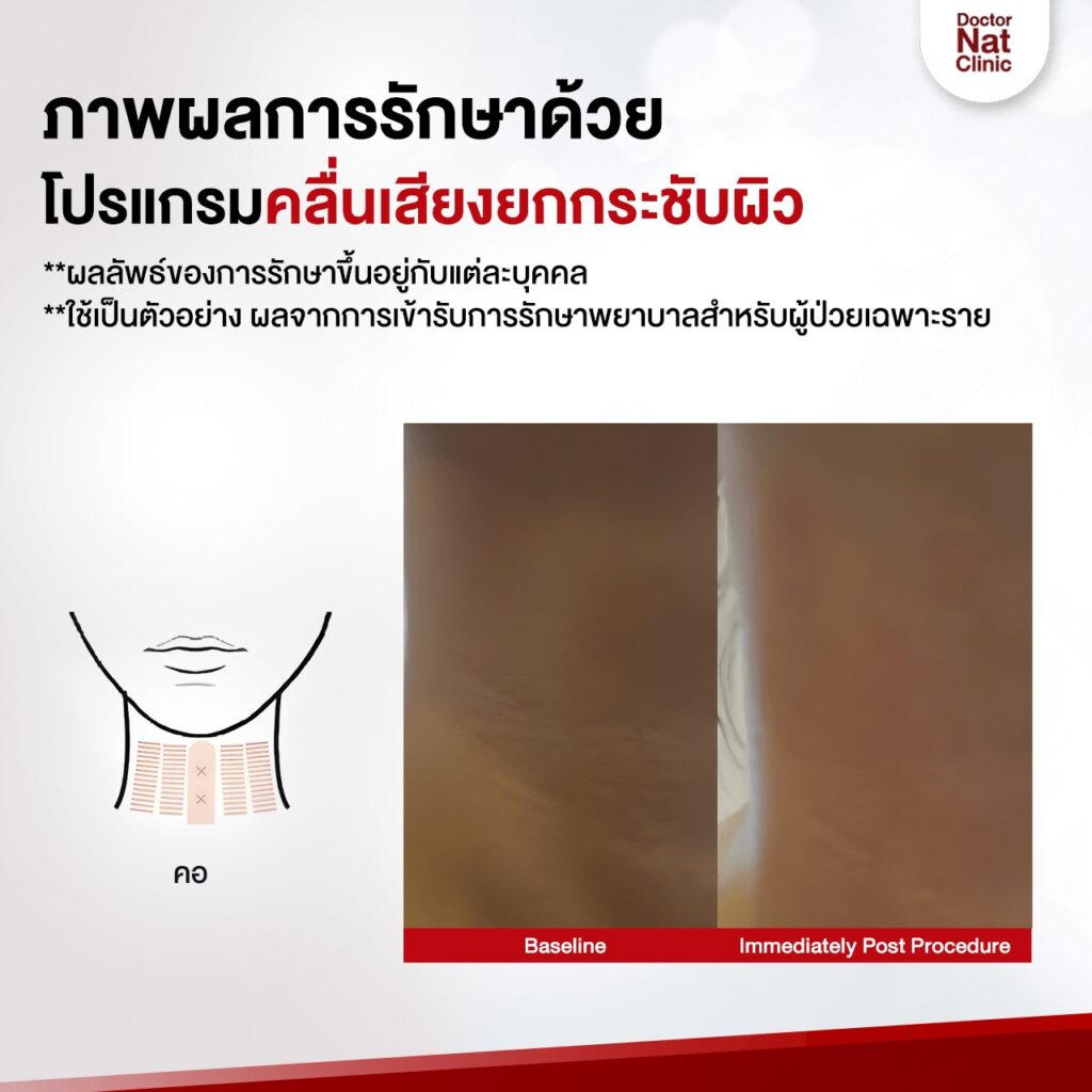 Ultraformer III ยกกระชับหน้า ไม่ต้องผ่าตัด - Doctor NAT Clinic