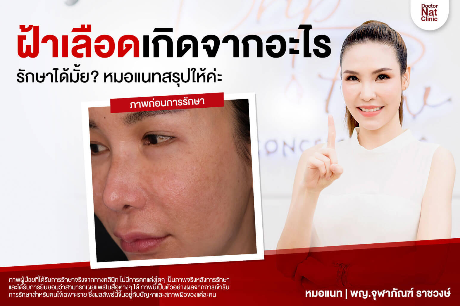 ฝ้าเลือดคืออะไร? เกิดจากอะไร? รักษาได้มั้ย? - Doctor NAT Clinic