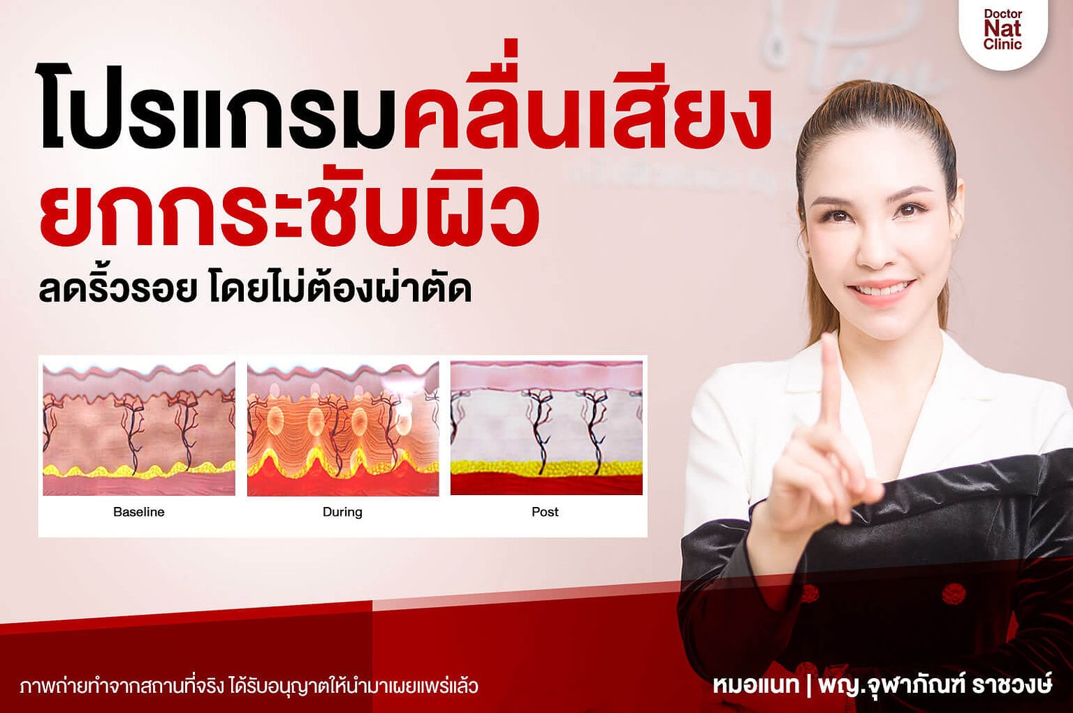 Ultraformer III ยกกระชับหน้า ไม่ต้องผ่าตัด - Doctor NAT Clinic