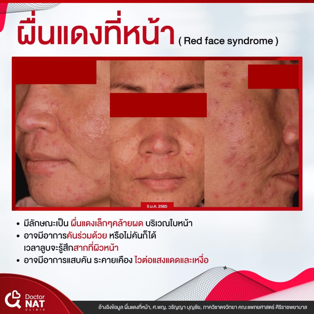 สิวตัวไร ผื่นแดง ผิวหนังอับเสบ จากไรขน รักษาได้ค่ะ - Doctor NAT Clinic