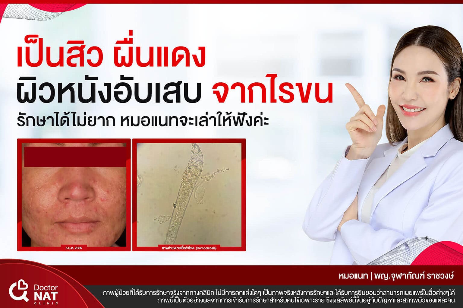 สิวตัวไร ผื่นแดง ผิวหนังอับเสบ จากไรขน รักษาได้ค่ะ - Doctor NAT Clinic