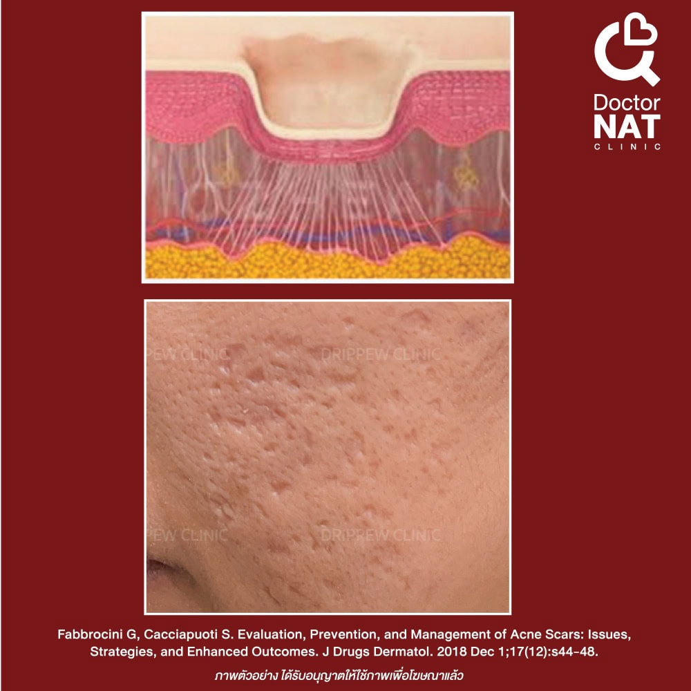 ไขข้อสงสัย เป็นหลุมสิว Boxcar scar รักษาอย่างไรให้หาย ? - Doctor NAT Clinic