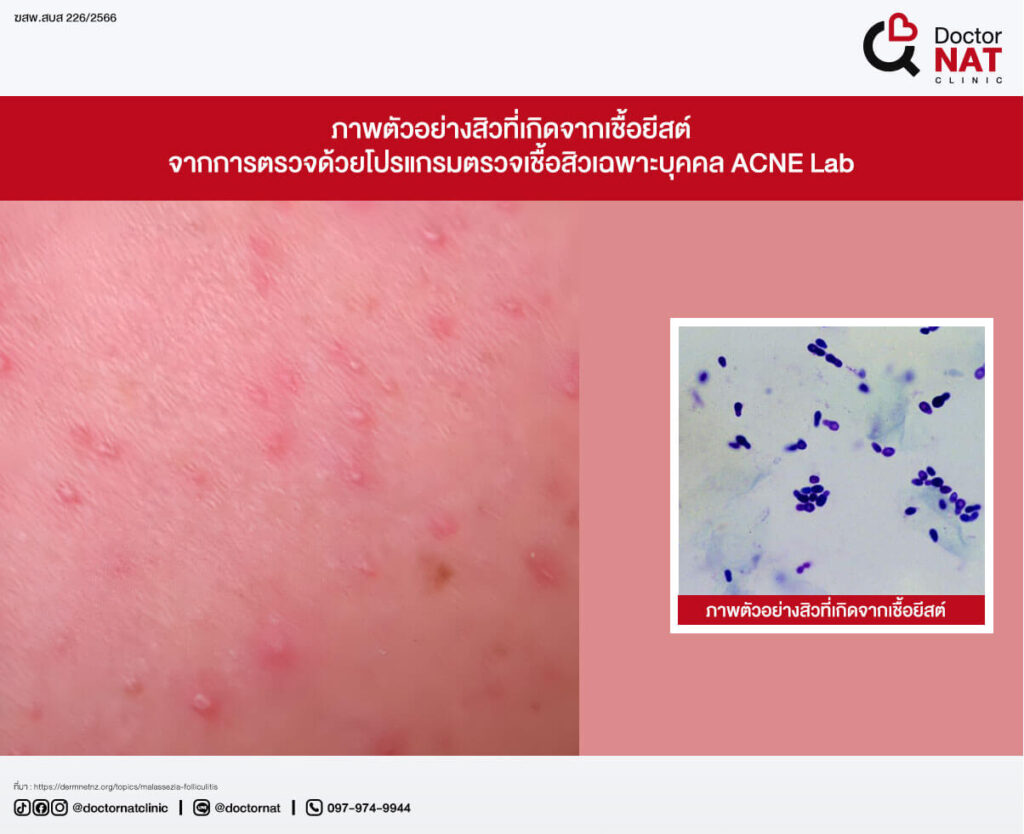 ทำไมถึงไม่ควรใช้ยาแต้มสิวเพียงอย่างเดียว? - Doctor NAT Clinic